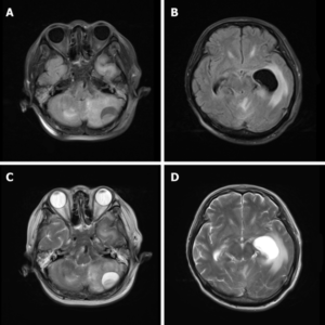 Algorithmically Detecting Brain Abscess Caused by Dental Infection ...