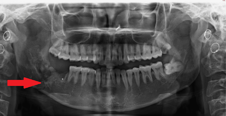 Iatrogenic Fracture of the Mandibular Angle During Wisdom Tooth Surgery ...