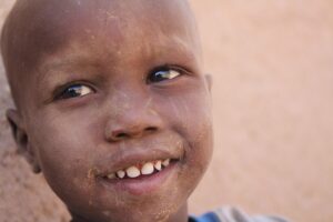 Why Some Kids Have "Chalky" Teeth: The Secret Role of Saliva ...